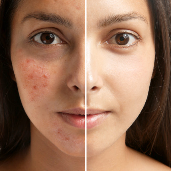 MazClarity Anti Acne Cream – Mazton Skin Solutions